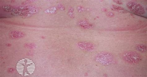 Chronic Plaque Psoriasis Image