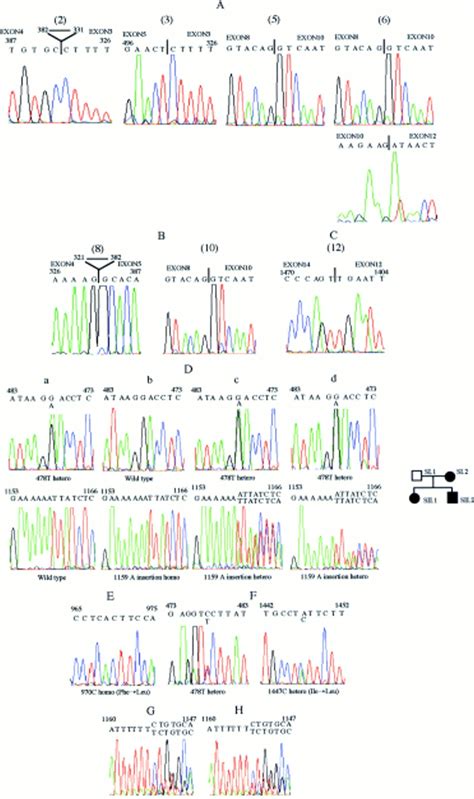 Identification Of Cryptic Splice Site Exon Skipping And Novel Point Mutations In Type I Cd36