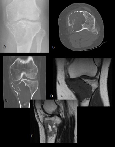 Well Defined Osteolytic Tumors A Review Of Clinical Aspects Imaging Findings Differential