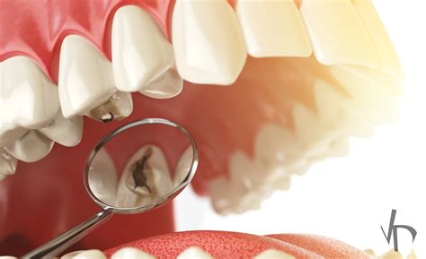 Cervical Caries Diagnosis And Treatment Features Vdm Dental Blog Ny