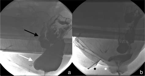 Defecating Proctography A Pictorial Essay Radiography