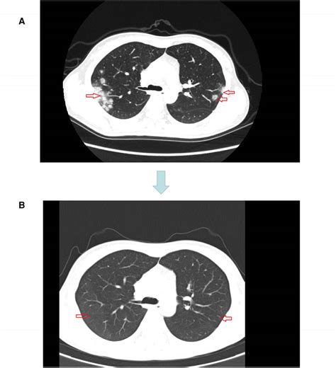 A Lung Image After Three Cycles Of Short Course Radiotherapy Xelox Download Scientific