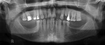 EMI Dental DL Object Detection Dataset And Pre Trained Model By EMI
