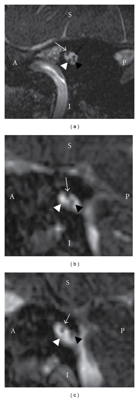 A Normal Sagittal Oblique 3d Ciss Mr Image Perpendicular To The Download Scientific Diagram