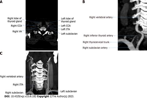 Computed Tomography A Origin Of Inferior Thyroid Artery From Left Download Scientific Diagram