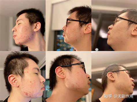 你们脸上的痘痘是用什么消掉的？ 知乎