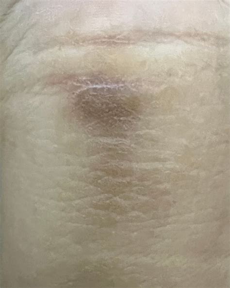 이게 뭔가요 한달전쯤 생겼고 점점 어두워져요 지식in