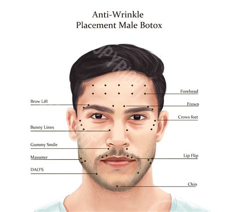 Male Botox Injection Points Bundle Botox And Filler Injector Anatomy