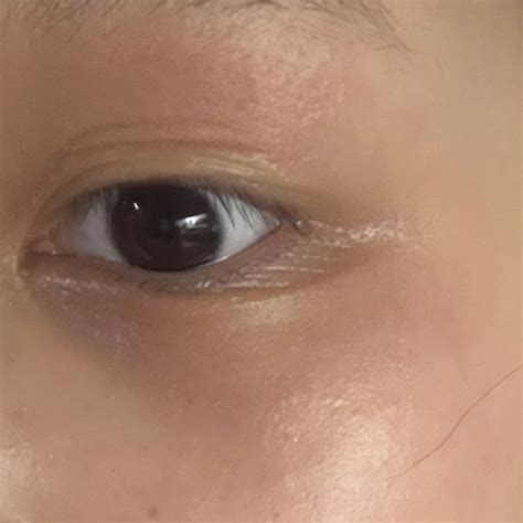 피부 뒤집어졋는데 도와주세요 ㅠㅠ 지식in