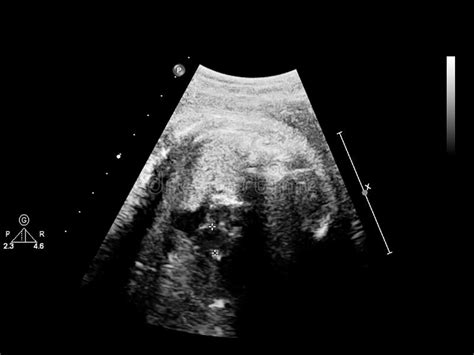 Ultrasound Scherm Met Foetale Echocardiografie Stock Afbeelding Image