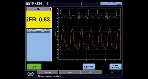 Ifr Matches Ffr Through 5 Years Ifr Swedeheart