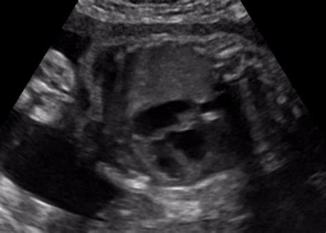 Atrial Septal Defect Ultrasound