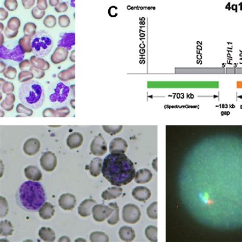 Clonal Evolution In A Patient With Csf3r T618i Cnl To Aml With