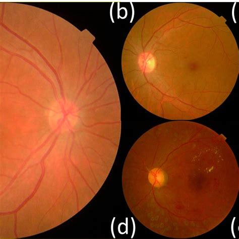 pdf diabetic retinopathy dr severity level classification using