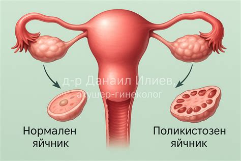 Киста на яйчника Симптоми рискове и лечение