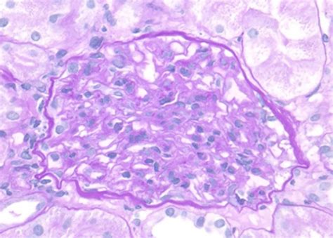 Biopsy Proven Streptococcus Suis Associated Infectious