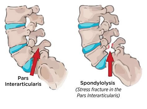 Spondy𝗹𝗼𝘀𝗶𝘀 Vs Spondy𝗹𝘆𝘁𝗶𝘀 Vs Spondy𝗹𝗼𝗹𝘆𝘀𝗶𝘀 Vs Spondy𝗹𝗼𝗹𝘆𝘀𝘁𝗵𝗲𝘀𝗶𝘀 Vs Prolapsed Inter Vertebral
