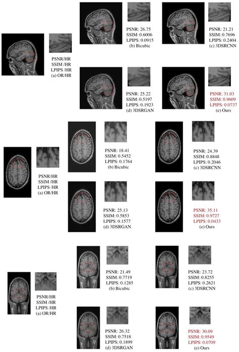 3d Mri Reconstruction Based On 2d Generative Adversarial Network Super Resolution Pmc