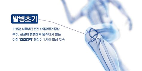 Linkedin Gc Labs 페이지 👟류마티스관절염은 조기 진단 시 관절의 파괴와 변형을 막을 수 있고 기능적 장애를 줄일 수 있습니다 그렇기 때문에 얼마나 조기에