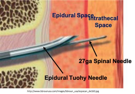 Caudal Anesthesia Technique