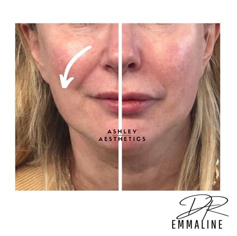 𝗗𝗿 𝗘𝗺𝗺𝗮𝗹𝗶𝗻𝗲 𝗔𝘀𝗵𝗹𝗲𝘆 On Instagram “a Subtle Bolus To The Piriform Fossa Will Lift And Soften The