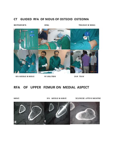 Rfa Procedure Radiofrequency Ablation ~ Radio Frequency Ablation Rf Ablation Surgery Rfa