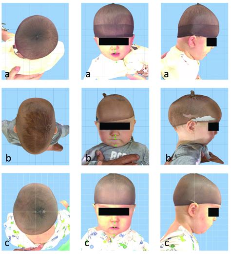 Positional Plagiocephaly