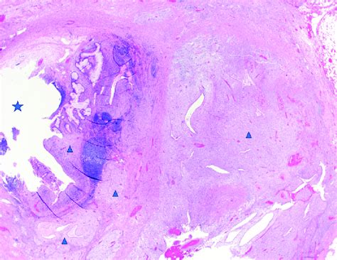 Histopathological Appearance Of The Appendix Haematoxylin And Eosin