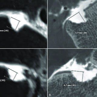 3d Mr And Flat Panel Ct Arthrography Measurements Multiplane