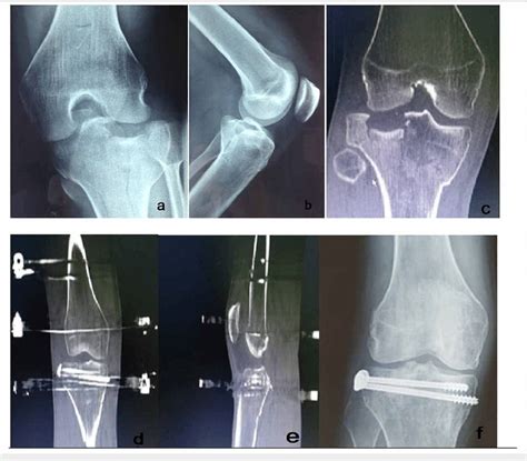 An 18 Year Old Man With A Displaced Bicondylar Tibial Plateau Fracture Download Scientific