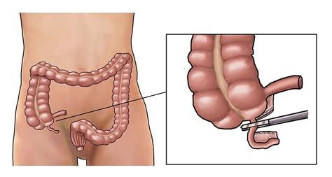 Appendicitis Surgery Appendectomy And Recovery