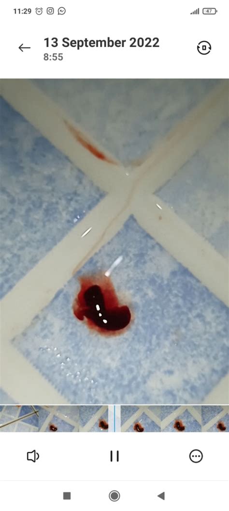 Bercak Flek Di Hellosehat