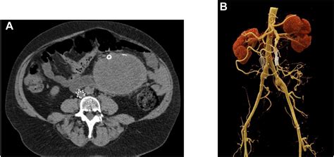 Superior Mesenteric Artery Aneurysm Endovascular Repair Journal Of