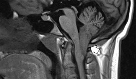 Figure T1 Weighted Axial Mri Shows A Type 1 Chiari Malformation Download Scientific Diagram