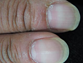 Do You Recognize These Nail Disorders Consultant360