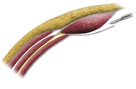 Posterior Component Separation Transversus Abdominis Release Pcs Tar