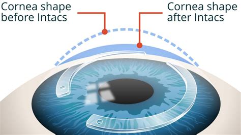 Keratoconus Treatment The Eye Practice