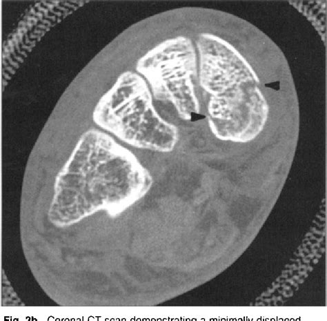 Figure 1 From Isolated Medial Cuneiform Fracture Review Of The Literature And Report Of Two