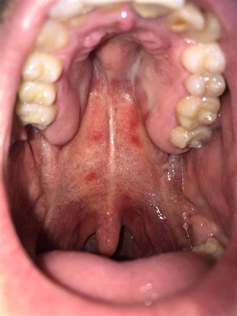 Red Spots Roof Of Mouth Raskdentists