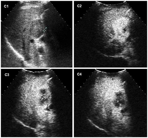 Intrahepatic Cholangiocellular Carcinoma Icc In A 42 Year Old Man Download Scientific Diagram