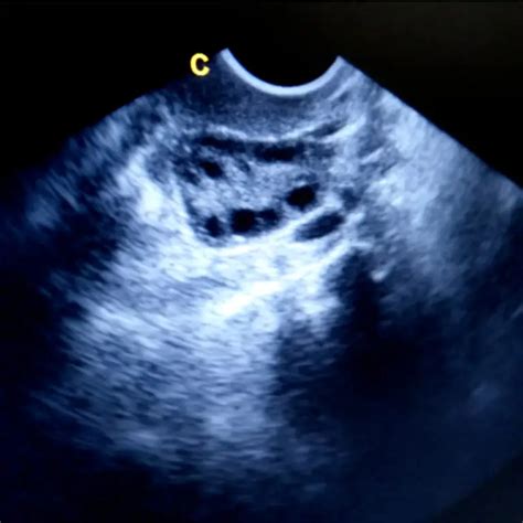How Is Polycystic Ovarian Syndrome Pcos Diagnosed