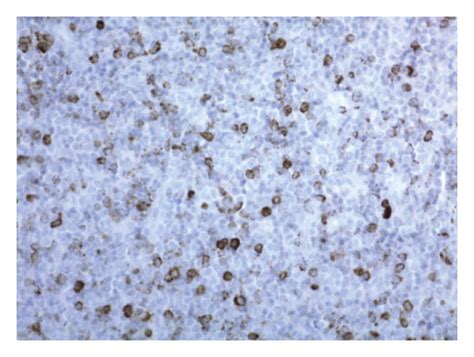 A The Dissected Neck Lymph Nodes Were Conglomerated B Normal Download Scientific Diagram