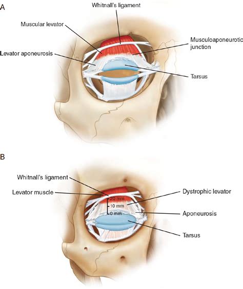 Superior Tarsal Muscle