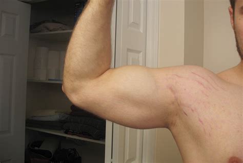 Bicep Stretch Marks