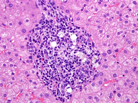 Pathology Outlines Acute T Cell Mediated Rejection