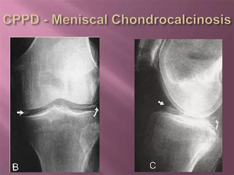 Metabolic Scurvy Gout Cppd Fluorosis Sayid Pptx
