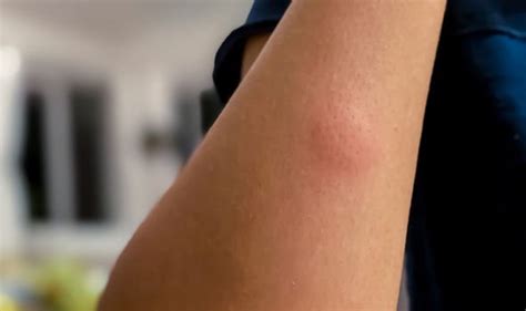 False Widow Bite Warning Five Signs Youve Been Bitten By The Uks Most Dangerous Spider
