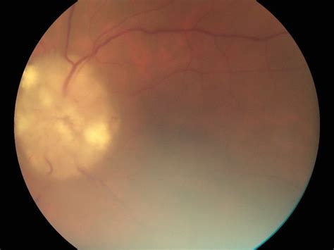 Ophthalmology Cases And Hypotheses Och Journal Posted On Linkedin