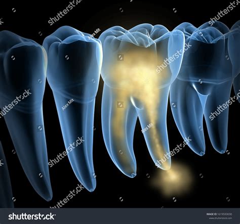 Molar Tooth Abscess Xray At Krystal Anaya Blog