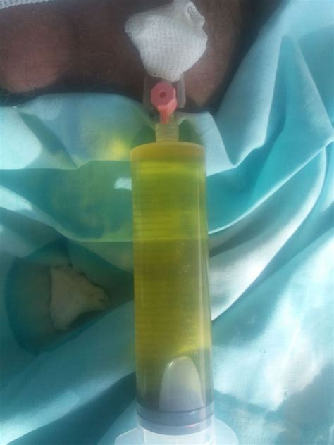 Hydro From Scrotum Medizzy